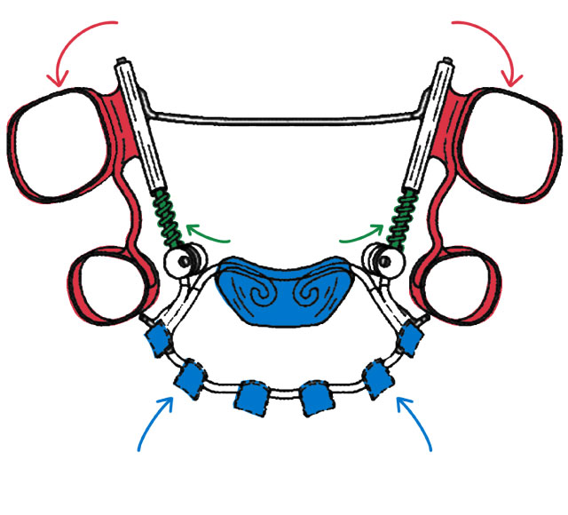 molar bands secure the agga to a patient s upper back teeth