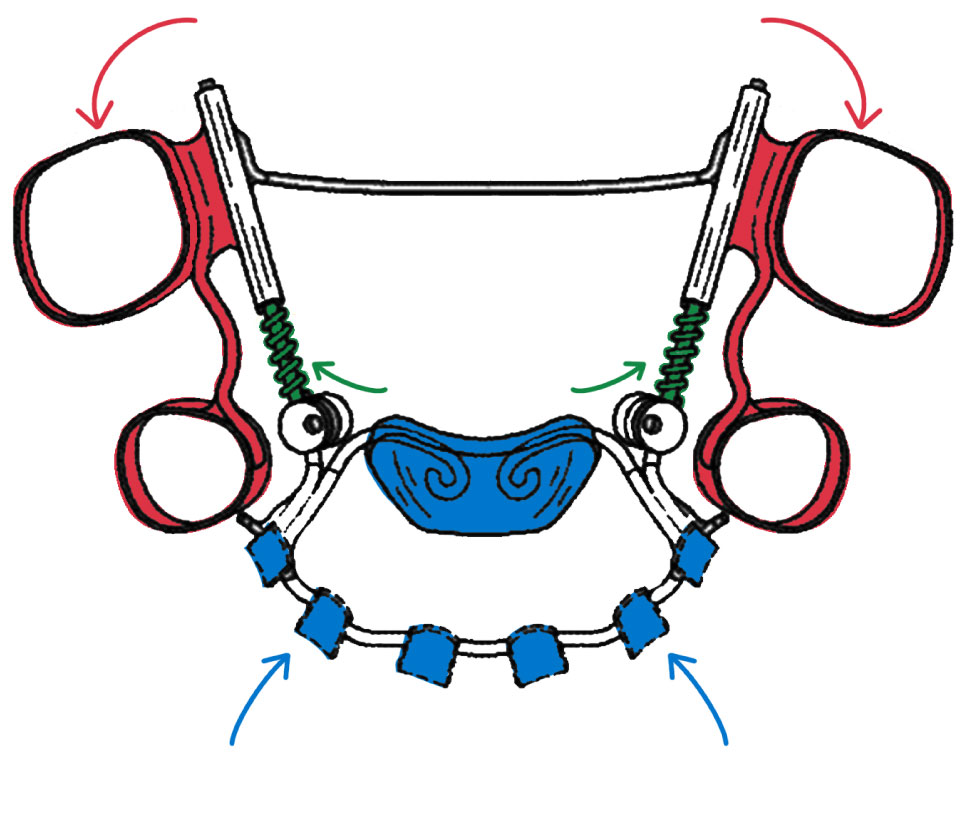 molar bands secure the agga to a patient s upper back teeth